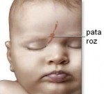 Iritatii si semne din nastere pe piele la nou-nascut