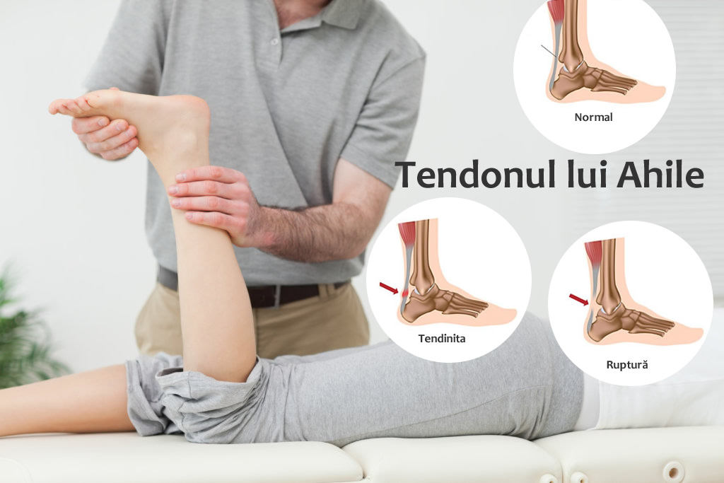 Leziunile tendonului calcanean / ahilean (tendonul lui Ahile)
