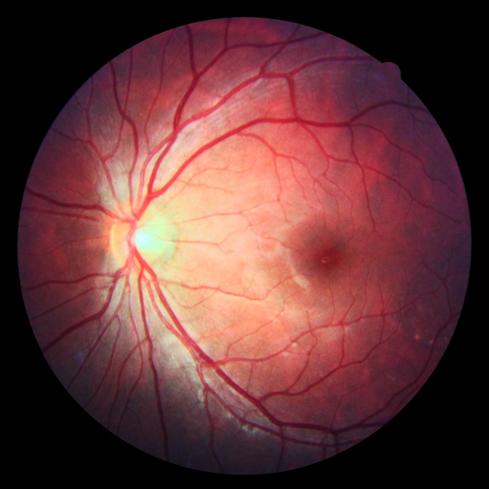 Hemoragiile vitreene