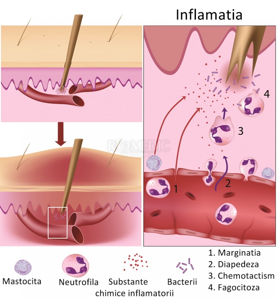 Reactia inflamatorie