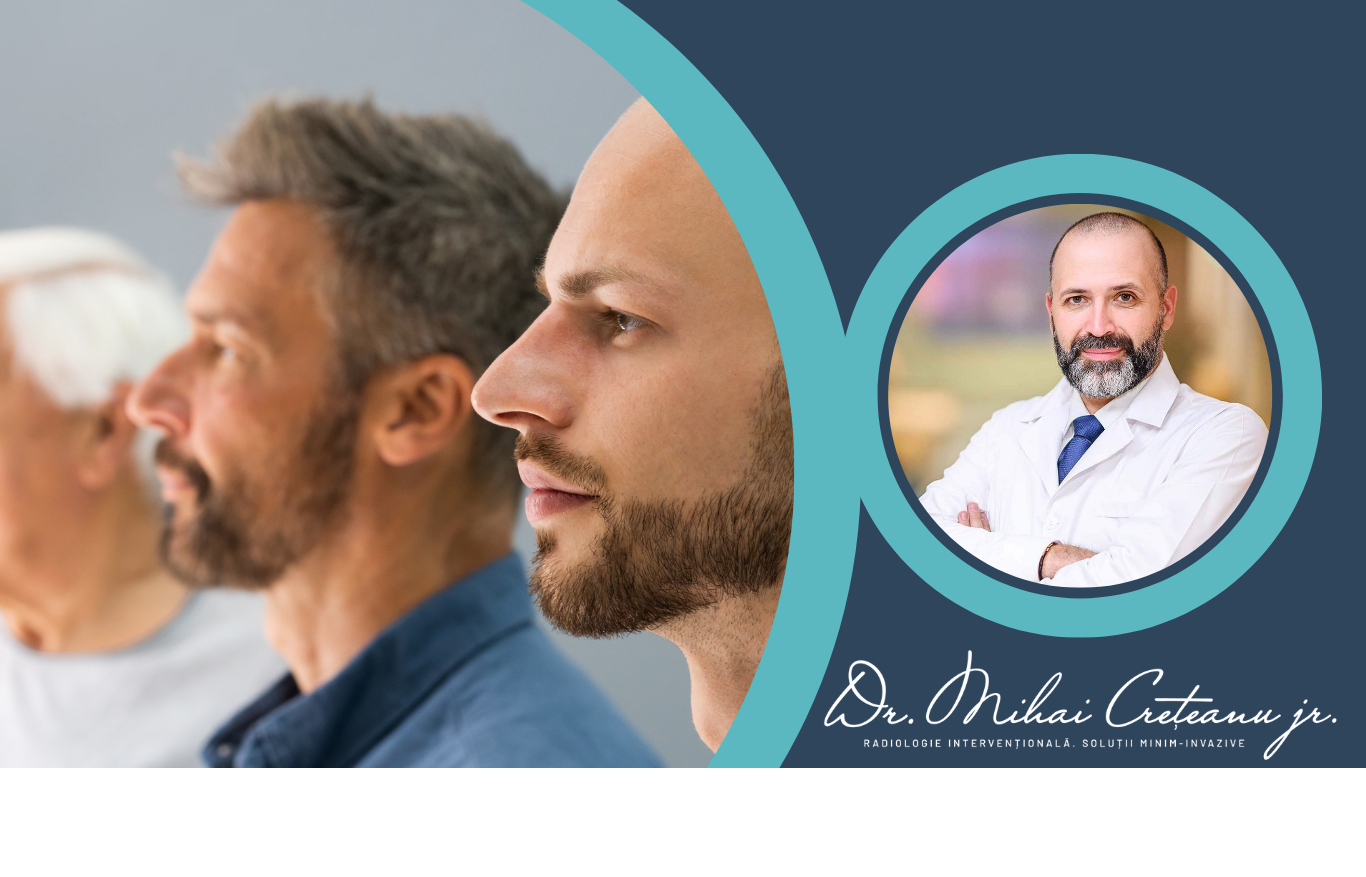 Embolizarea varicocelului – O soluție modernă și eficientă pentru ...