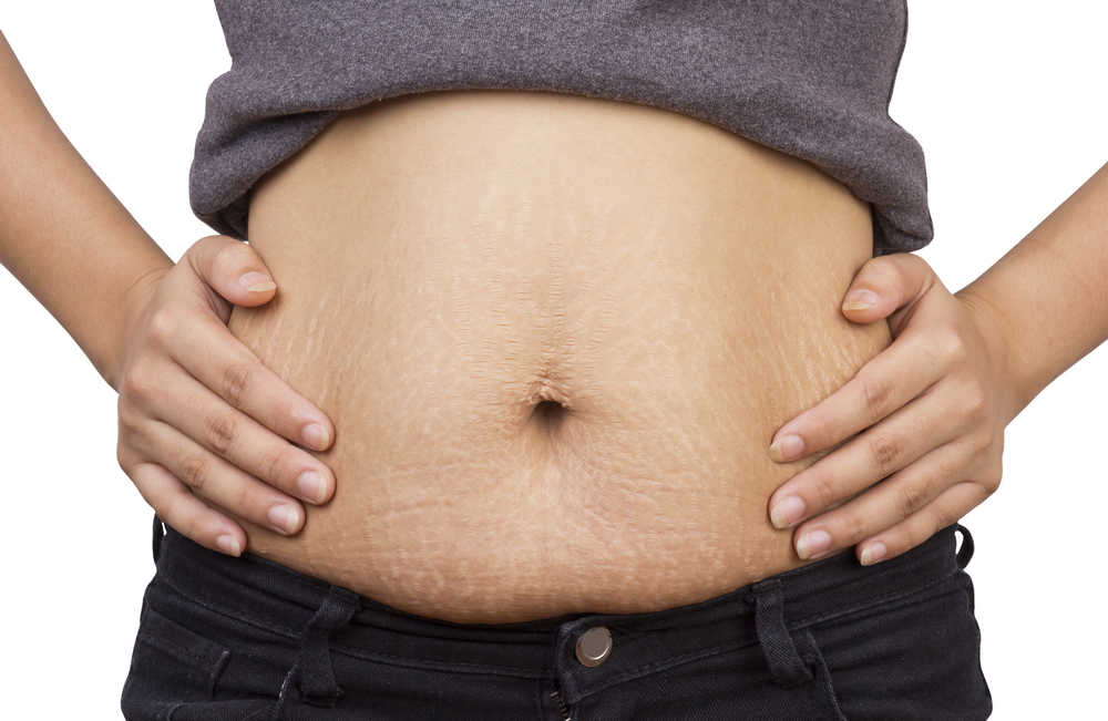 Vergeturile după naștere