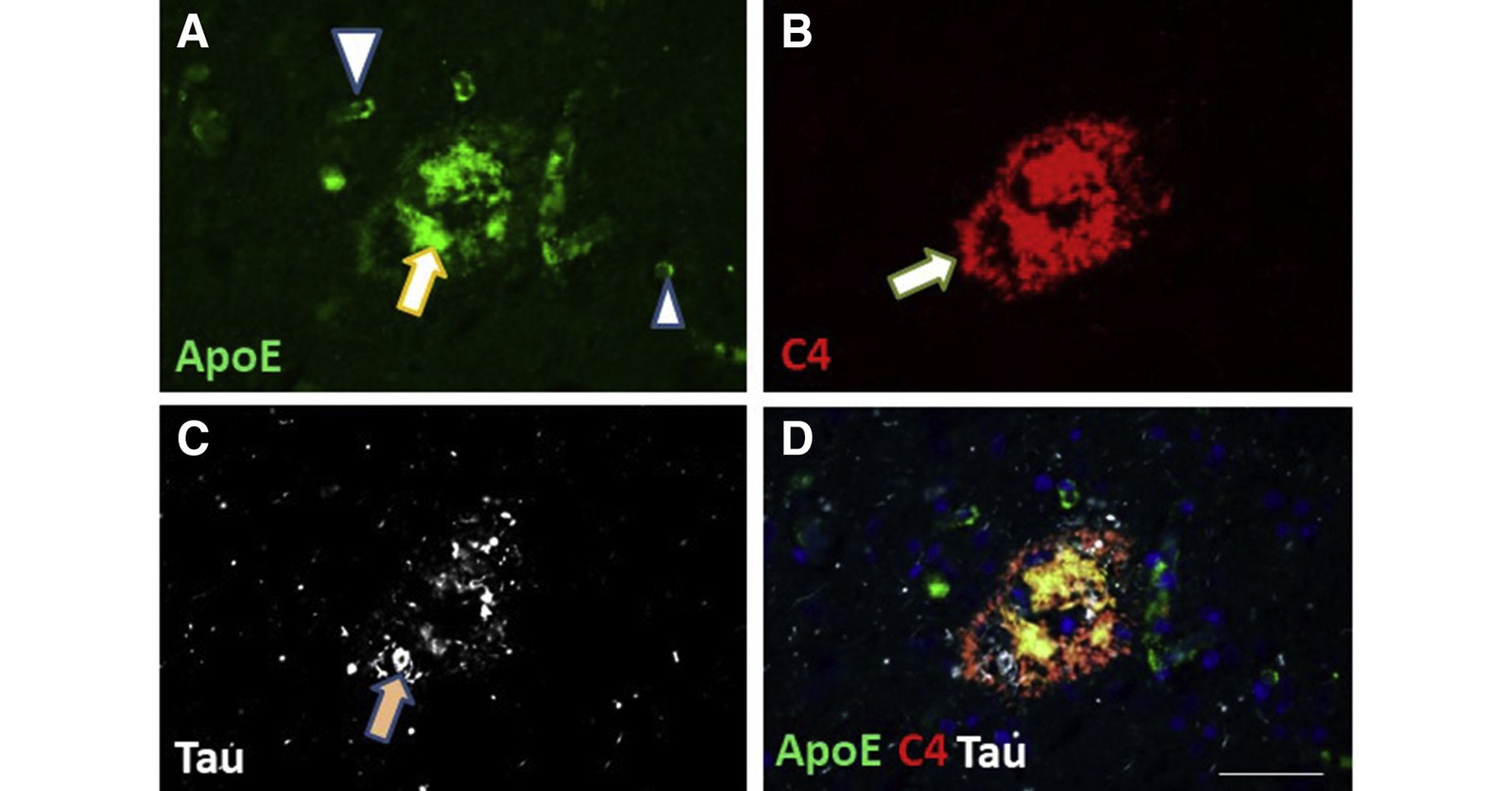 Apolipoproteina E fără mutații, asociată cu semne de demență în ...