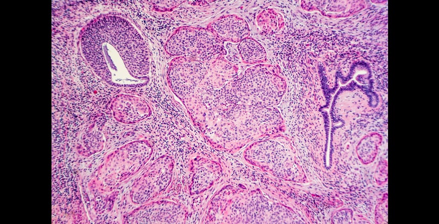 Transformările virale de la nivelul tractului genital pot cauza ...