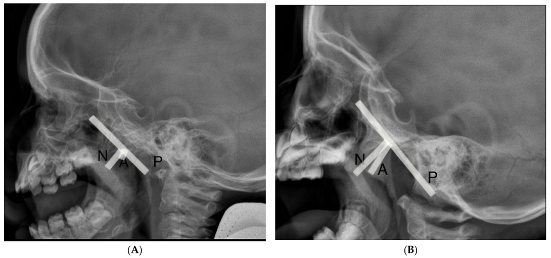 Hipertrofia adenoidiană are cauze genetice și virale, potrivit unui nou ...