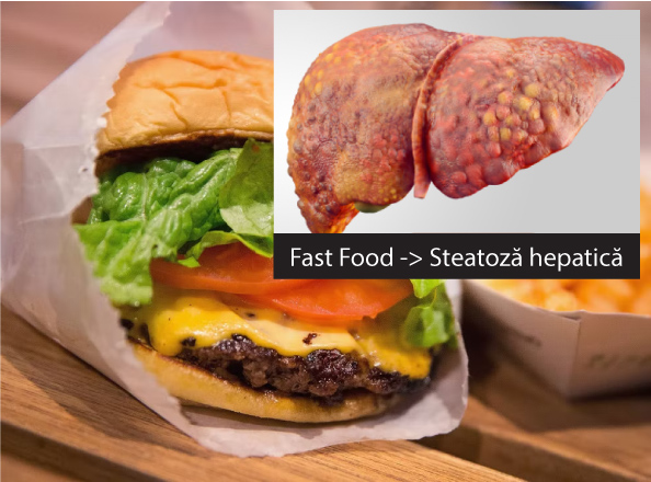 Există o asociere clară între consumul de fast food și steatoza ...