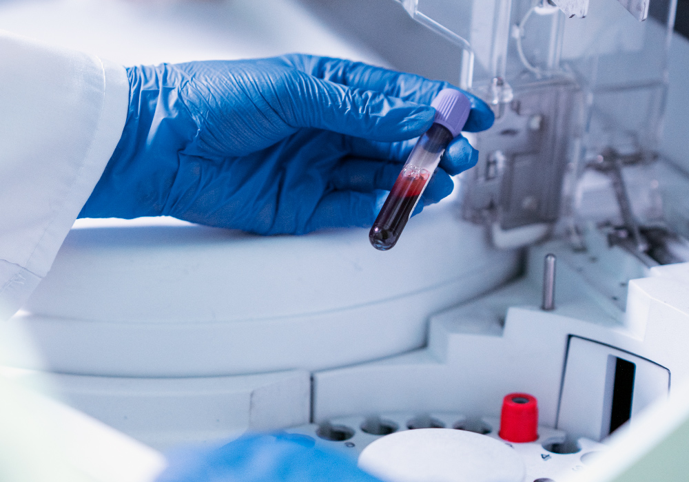 Virusul Epstein-Barr agravează colita ulcerativă prin declanșarea ...