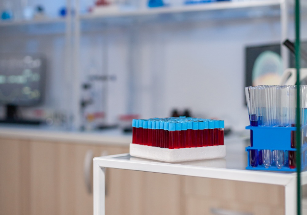 Biomarkerii din sânge pot detecta acumularea timpurie de amiloid în ...