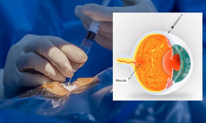 Injecții intraoculare (în ochi, intravitreene) | Proceduri medicale