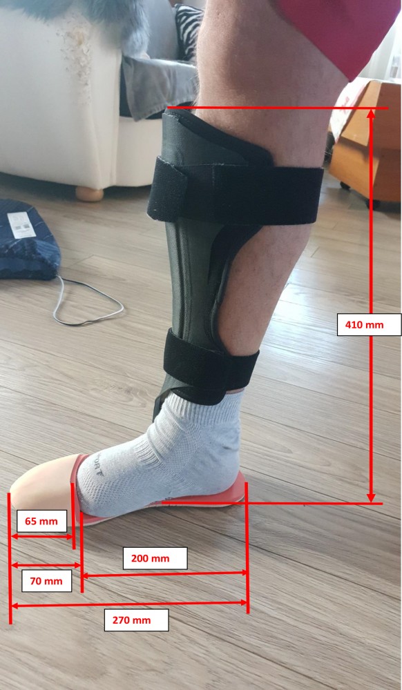 Proteza/orteza tip CHOPARD pentru amputatie metatarsiene | Anunturi ...