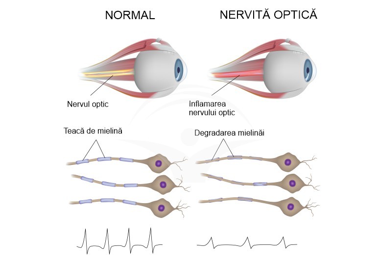 Boli ale nervului optic și ale căii optice | Reprezentanta ...
